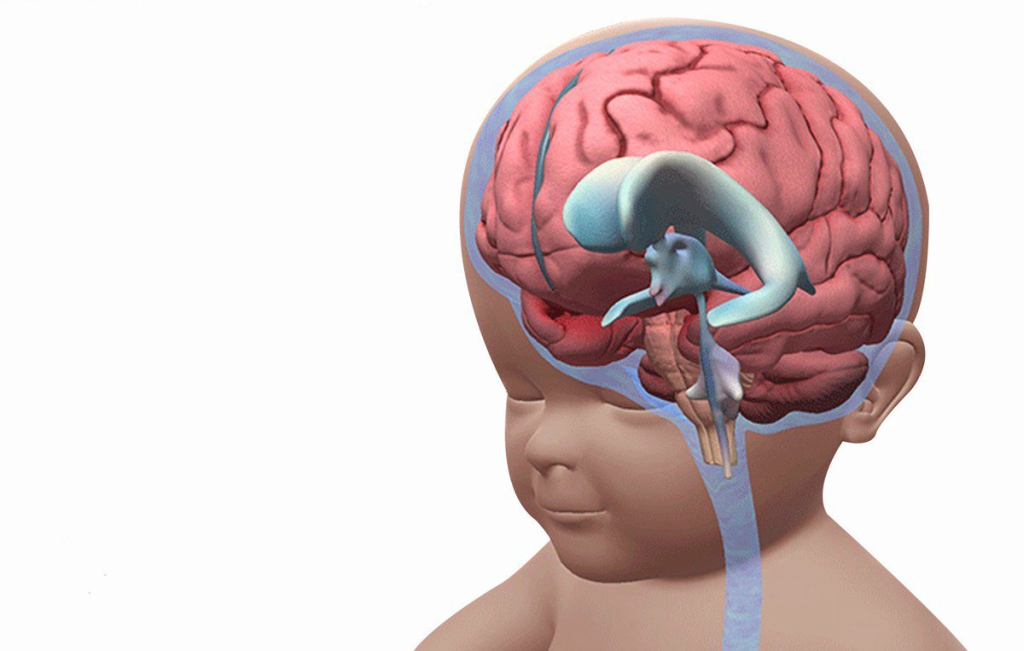 Hidrocefalia: síntomas y tratamientos para curar esta enfermedad